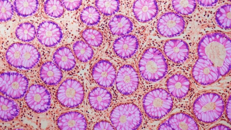 Research Links Iron-Mediated Cell Death and Inflammatory Bowel Disease ...